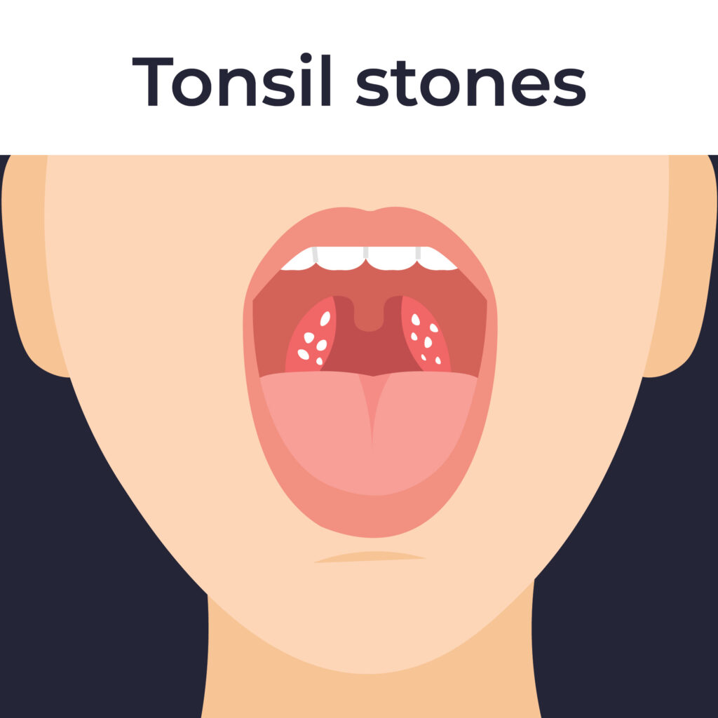 Understanding Tonsil Stones: Causes, Removal, and Prevention